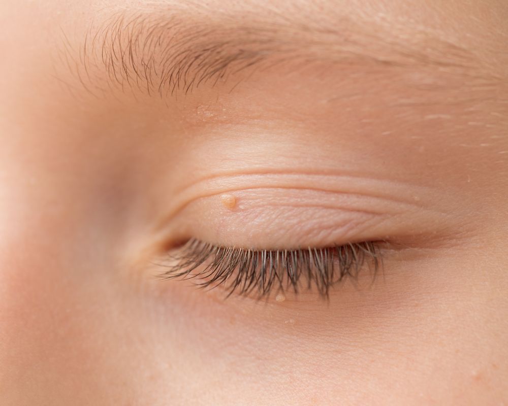 Brodawki na powiece, brodawki na oku, brodawki na powiece domowe ...