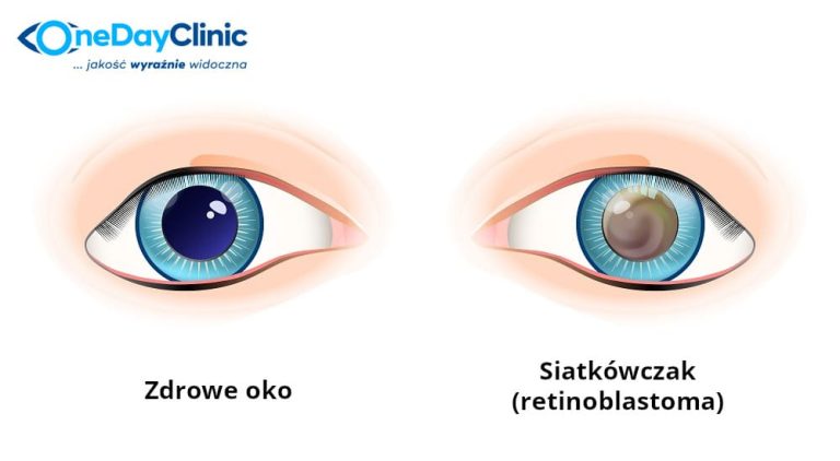 Siatkówczak, rak oka, siatkówczak u dziecka, siatkówczak objawy, guz ...