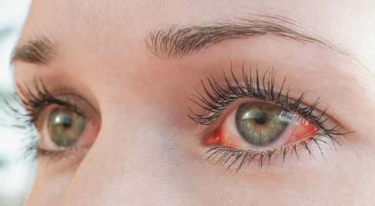 Owrzodzenie rogówki oka przyczyny, objawy, leczenie, wrzód rogówki ...